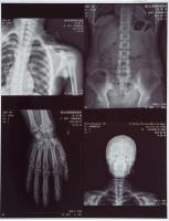 China Blue Color 10x12 Inch Inkjet Medical X-ray Film for CT DR MRI 125um for sale
