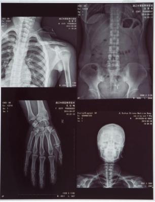 China Blue Color 10x12 Inch Inkjet Medical X-ray Film for CT DR MRI 125um for sale