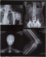 China Blue Color 10x12 Inch Inkjet Medical X-ray Film for CT DR MRI 125um for sale