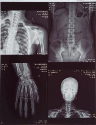 China Medical X Ray Film FUJI DIHT 14x17in Laser Dry Imaging Film 100 Sheets per Box for sale