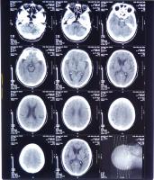 China Blue Medical X Ray Film 10x12 inch 210 Micron for Inkjet Printer Clear Imaging for sale