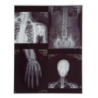 China 210 Microns Medical X Ray Film Inkjet Laser for CT DR MR 8x10 Inch for sale