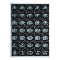 China 210 Microns Medical X Ray Film Inkjet Laser for CT DR MR 8x10 Inch for sale