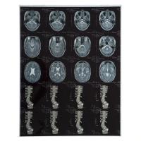 China Medical Laser X Ray Film 14x17 for Fuji Drypix 4000 6000 Printer CE Certified for sale
