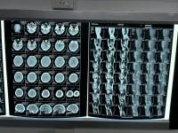 China Kefu Blue Laser X Ray Thermal Print Film 8x10 to 14x17 in Single Use Radiological Imaging for sale