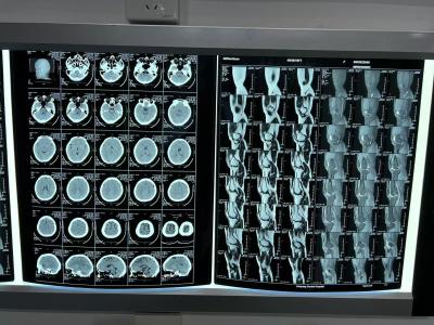 China Kefu Blue Laser X Ray Thermal Print Film 8x10 to 14x17 in Single Use Radiological Imaging for sale