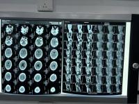 China Kefu PTF HJF Laser X Ray Film 0.28D Min Density Blue for Medical Imaging for sale