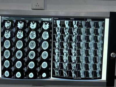 China Kefu PTF HJF Laser X Ray Film 0.28D Min Density Blue for Medical Imaging for sale