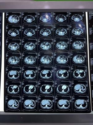China Blue Laser X Ray Thermal Print Film 8x10 to 14x17 Max Density 3.0D for CT MRI for sale