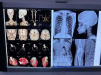 China Kefu Blue Laser X Ray Film 8x10 to 14x17 Single Use Thermal Print Moisture Proof for sale