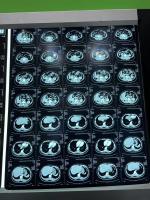 China Kefu PTF HJF Blue Laser Medical X Ray Film 14x17 inch 100 Sheets Thermal Print for sale
