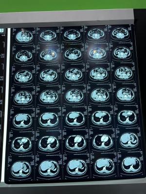 China Kefu PTF HJF Blue Laser Medical X Ray Film 14x17 inch 100 Sheets Thermal Print for sale