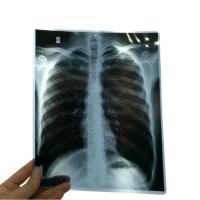 China 14x17 Inch Medical X-Ray Dry Film 200μm PET for Laser and Thermal Printers for sale