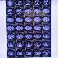 China Inkjet X Ray Film 9600x2400dpi Medical Blue Film 125-210 Microns for Canon Epson Printers for sale