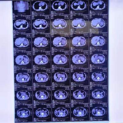 China Inkjet X Ray Film 9600x2400dpi Medical Blue Film 125-210 Microns for Canon Epson Printers for sale