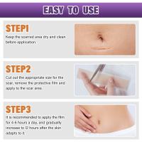 China Wholesale Silicone Scar Sheets | Factory Grade Medical Silicone Scar Tape for sale