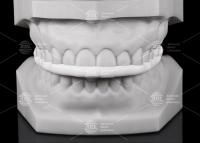 China Breathable Nylon Occlusal Splint for Nighttime Teeth Grinding Comfortable and Long-lasting for sale