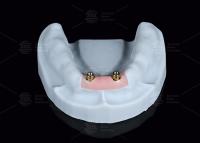 China Overdenture Locator Attachments Titanium Bracket Locator Denture Attachments for sale