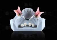 China CE FDA Ball Attachment Dentures Comfortable Denture Ball Attachment Long Lasting for sale