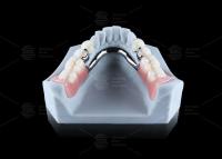 China CE FDA Ball Attachment Dentures Comfortable Denture Ball Attachment Long Lasting for sale