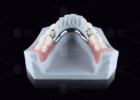 China CEKA M2 Precision Attachment Titanium With 3mm Horizontal / Vertical Clearances for sale