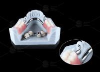 China 0.1mm Tolerance CEKA REVAX Attachment Titanium 3mm Vertical Clearance for sale