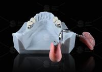 China Sleek Precision ERA Dental Attachments For Universal Secure Dental Prosthetics for sale
