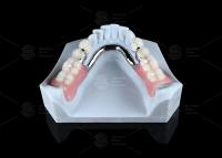 China Sleek Precision ERA Dental Attachments For Universal Secure Dental Prosthetics for sale
