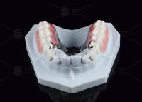 China Silver Key And Keyway Attachment Easy Maintenance Precision Attachment Dental for sale