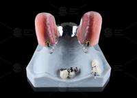 China Silver Key And Keyway Attachment Easy Maintenance Precision Attachment Dental for sale