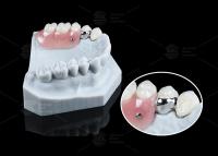 China MK1 Precision Attachment Removable Partial Denture Easy Installation for sale
