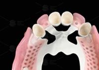 China Biocompatibility Dental Telescope White Inner Zirconia Outer Peek Telescope Dental for sale