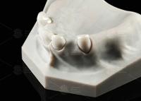 China Biocompatibility Dental Telescope White Inner Zirconia Outer Peek Telescope Dental for sale