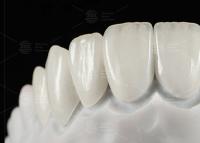 China Natural Pressed EMAX Veneer Strength 16 Shades Emax Teeth Veneers for sale