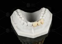 China Durable Hypoallergenic EMAX Bridge Extreme Esthetics Emax Dental Bridge for sale