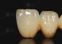 China A3 A3.5 Porcelain Fused To Metal Co Cr And Ceramic Dental Crown PFM Cad Cam for sale