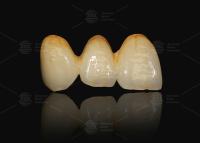 China A3 A3.5 Porcelain Fused To Metal Co Cr And Ceramic Dental Crown PFM Cad Cam for sale