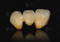 China A3 A3.5 Porcelain Fused To Metal Co Cr And Ceramic Dental Crown PFM Cad Cam for sale