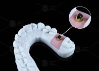 China Customized Titanium Base Corrosion Resistance Dental Implants And Solutions for sale