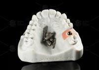 China Precision Titanium Digital Implant Scan Body Sandblasted Surface For Cad/Cam for sale