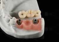 China Screw Retained Titanium Custom Abutment Porcelain Fused To Zirconia for sale