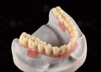 China Composite Pink Porcelain Crown A1 Shade All On 4 Hybrid Titanium Screw Retained for sale