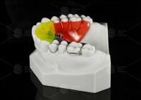 China Stainless Steel Acrylic Screw Expander Orthodontic Treatment Removable for sale