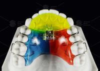 China Stainless Steel Acrylic Screw Expander Orthodontic Treatment Removable for sale