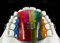 China Teeth Expansion And Distalization Palate Expander Orthodontic Expander for sale