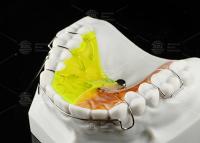 China Orthodontic Fan Shaped Expander Provides Posterior Crossbite Free Section Expansion for sale