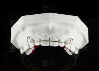 China Comfortable Stainless Steel Acrylic Hawley Retainer Effective Orthodontic Solution for sale