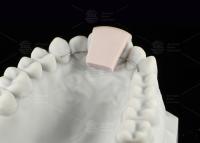 China Non Removable Lingual Wire Retainer Invisible Direct Bonded Lingual Retainer Wire for sale