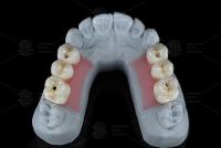China Reinforcement Implant Bar CAD CAM Designed For Precision Fit Compatible With Most Dental Implant Systems Ensuring Dental Restoration Solutions Chinese Dental Lab for sale