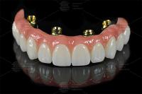 China All On X Implant Retained Bar with Screw Retained Zirconia Bridge Engineered To Deliver Superior Retention And Stability Chinese Dental Lab for sale